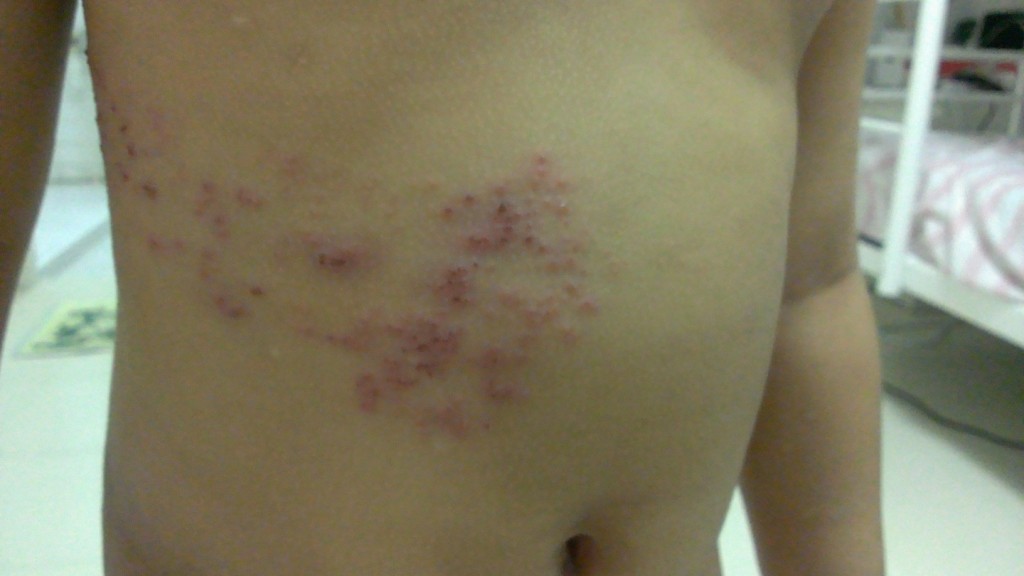 Shingles for Eczema Child - Eczema Blues