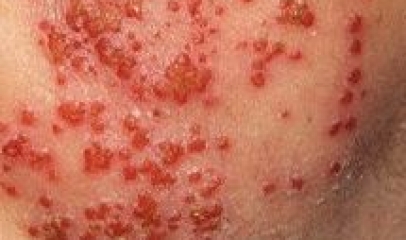 eczema herpeticum – Eczema Blues
